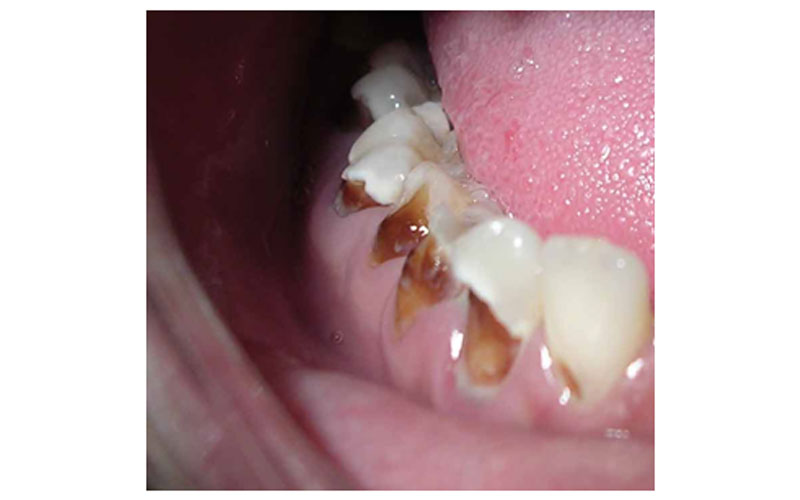 What Causes Cavities and How They’re Treated - The Blogging Doctors